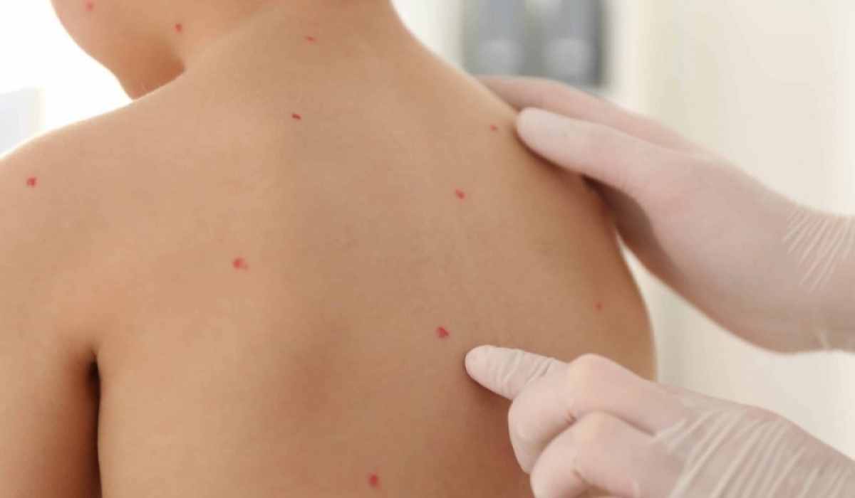 Л Хуягбаатар Салхин цэцгийн хамгийн түгээмэл хүндрэл арьсны идээт үрэвсэл